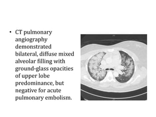 Neurogenic Pulmonary Edema | PPTX
