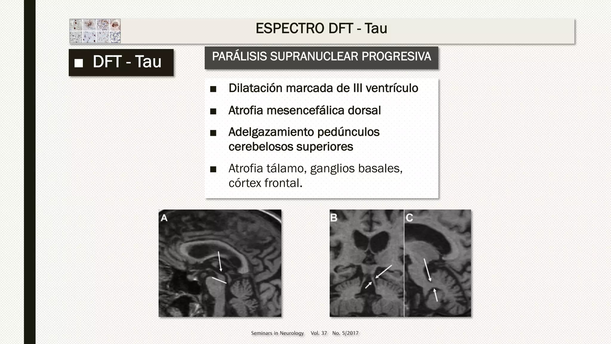 Neuroimagen estructural demencias | PDF
