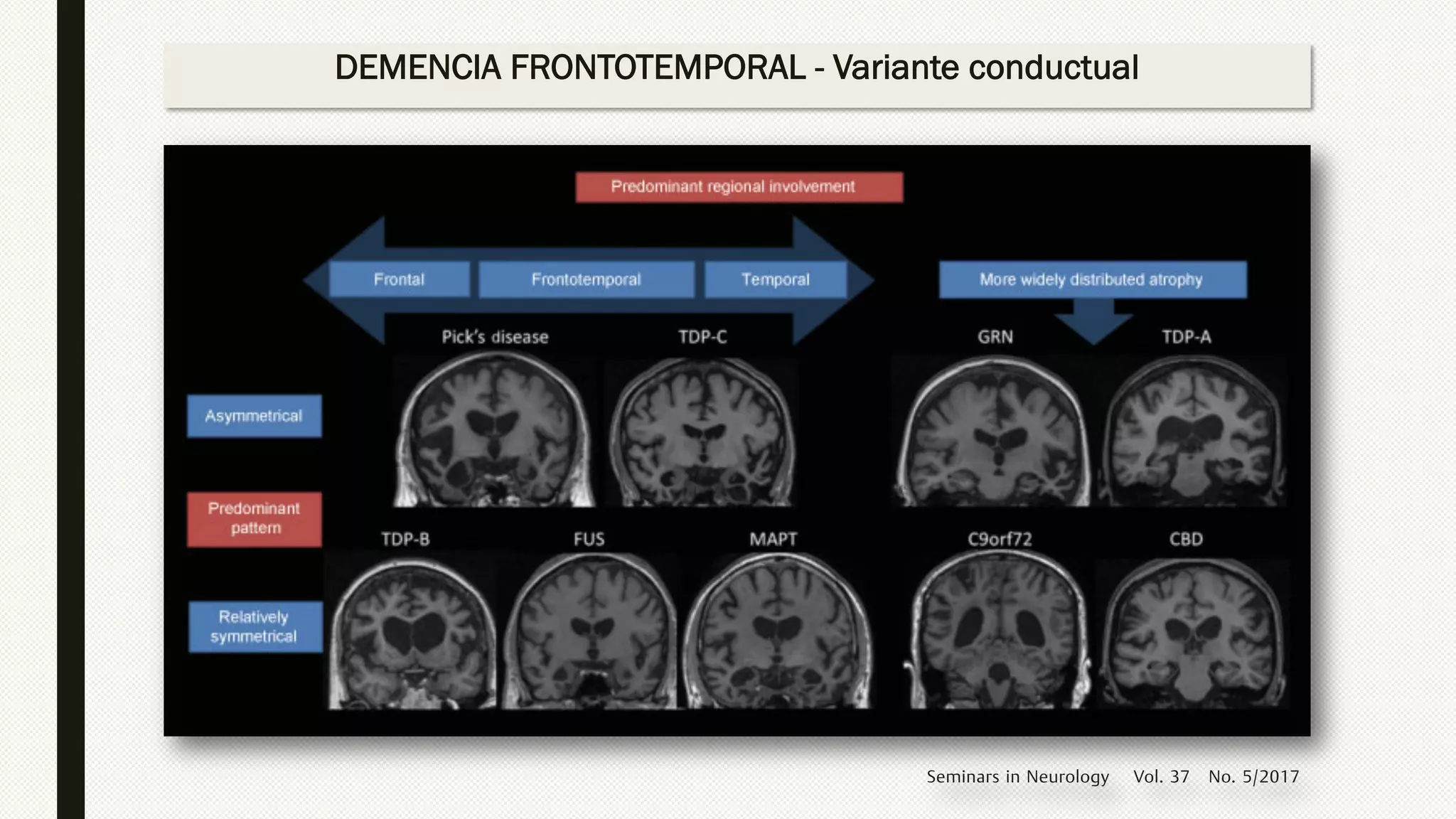 Neuroimagen estructural demencias | PDF