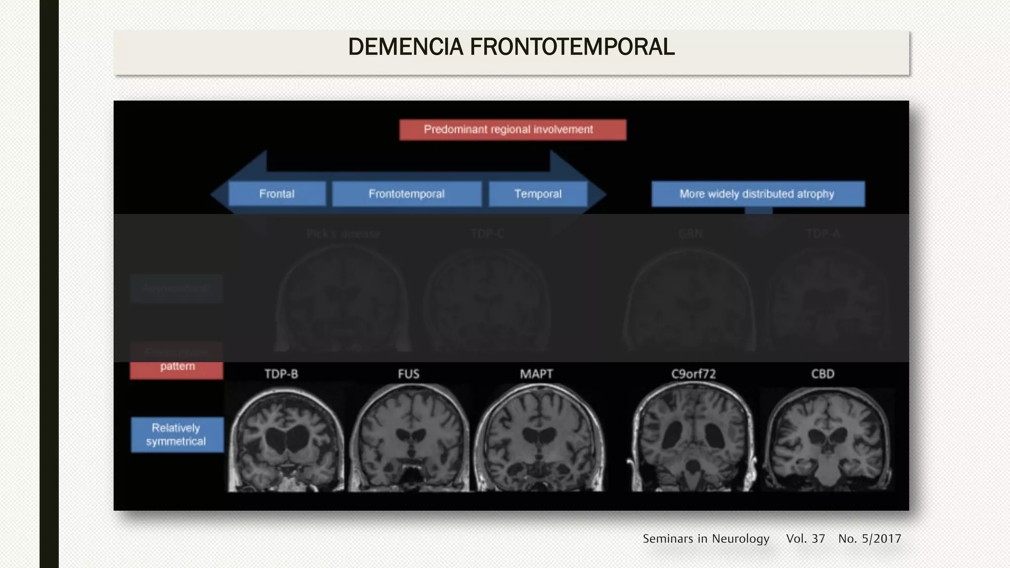 Neuroimagen estructural demencias | PDF