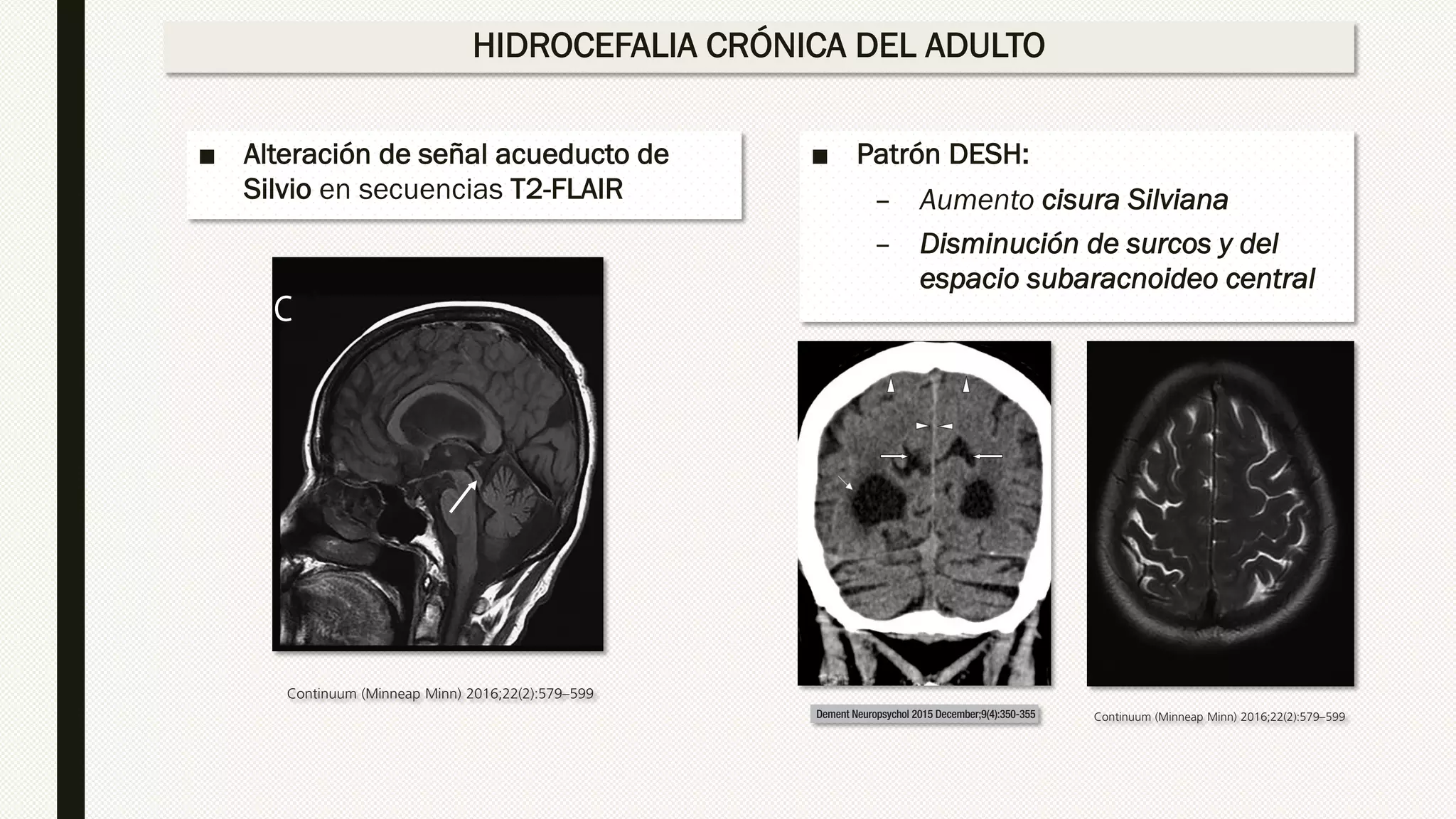 Neuroimagen estructural demencias | PDF