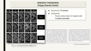 Neuroimagen estructural demencias | PPT