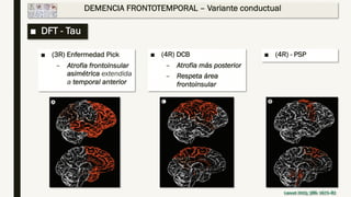 Neuroimagen estructural demencias | PPT