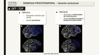 Neuroimagen estructural demencias | PDF