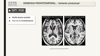 Neuroimagen estructural demencias | PDF