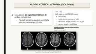 Neuroimagen estructural demencias | PPT