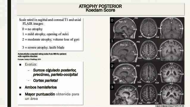 Neuroimagen estructural demencias