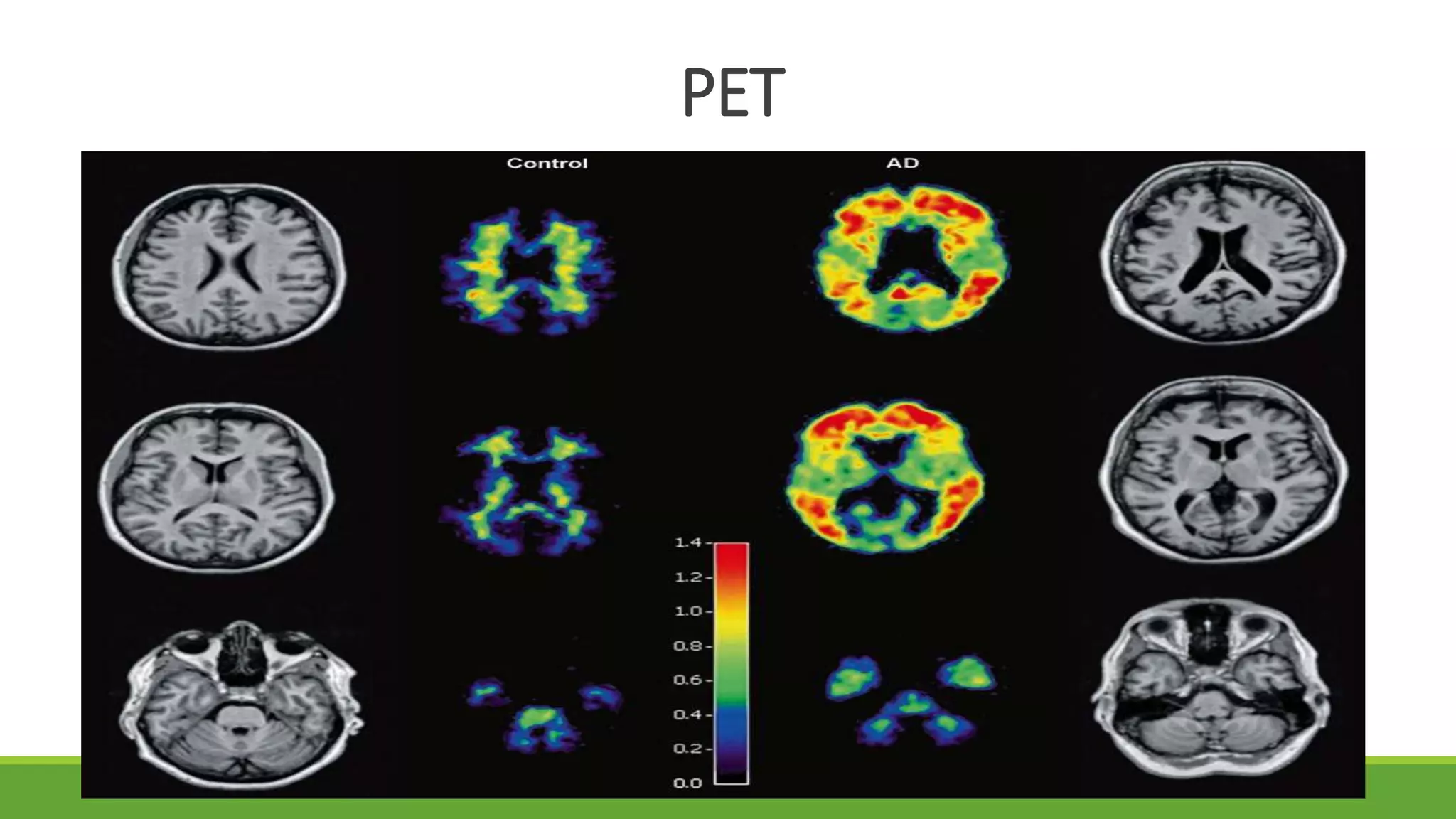 Neuroimaging in dementia | PPTX