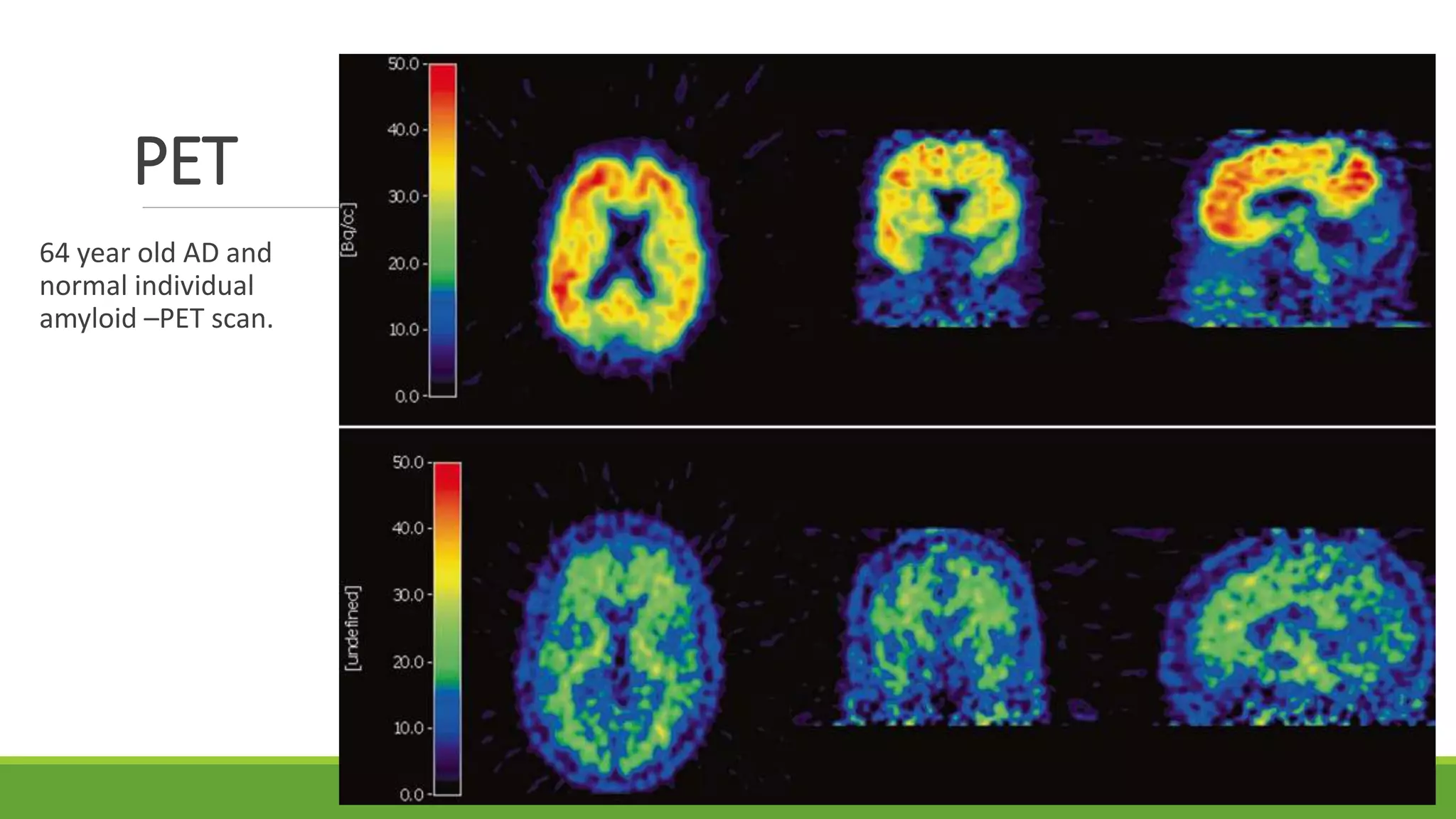 Neuroimaging in dementia | PPTX