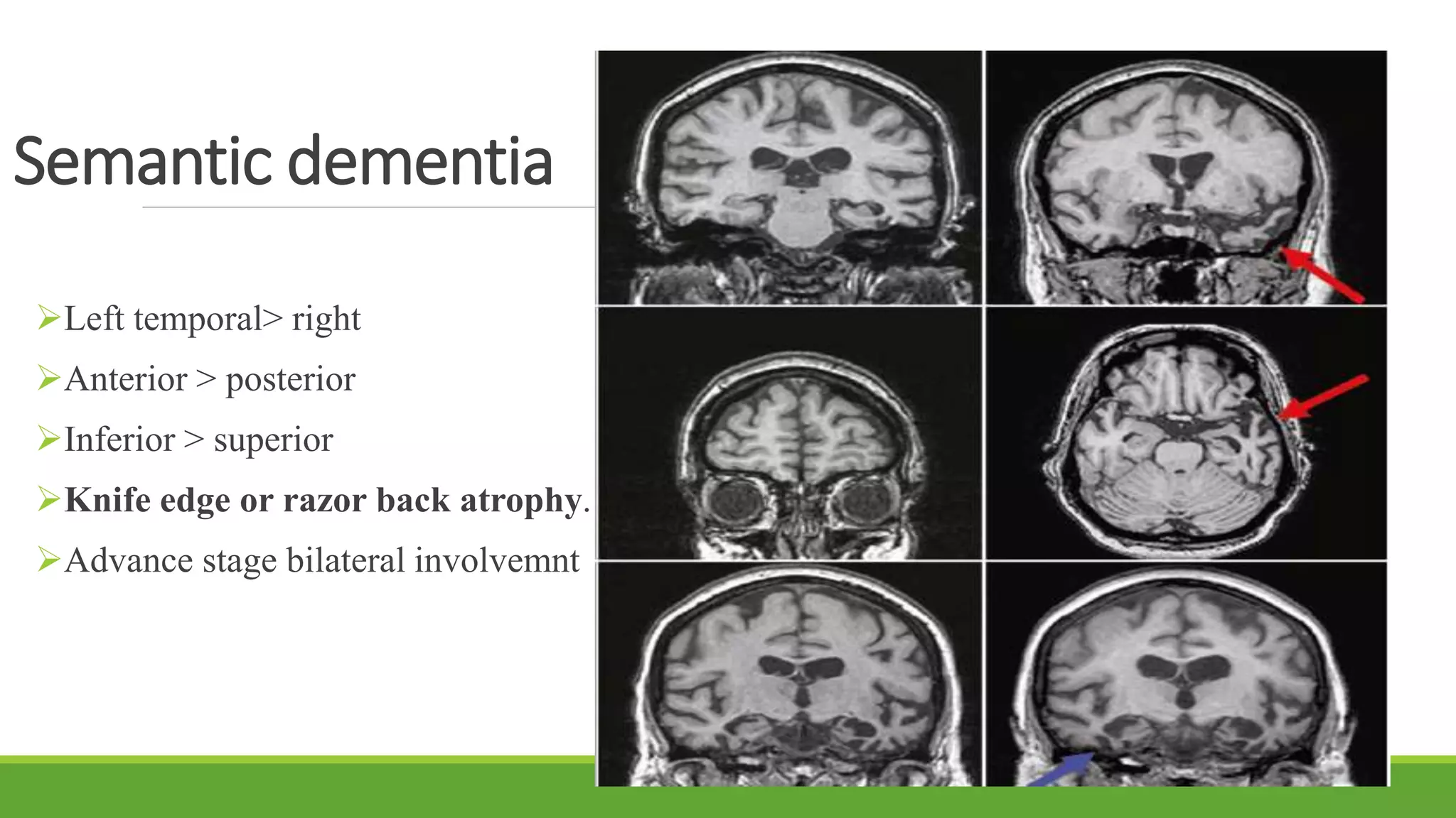 Neuroimaging in dementia | PPTX