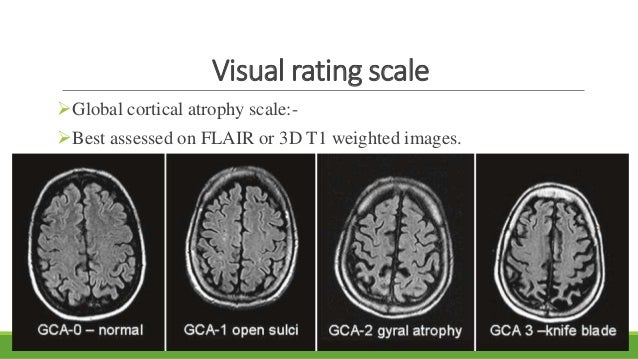 Neuroimaging in dementia