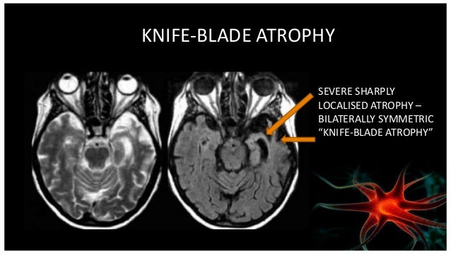 NEUROIMAGING IN PSYCHIATRY