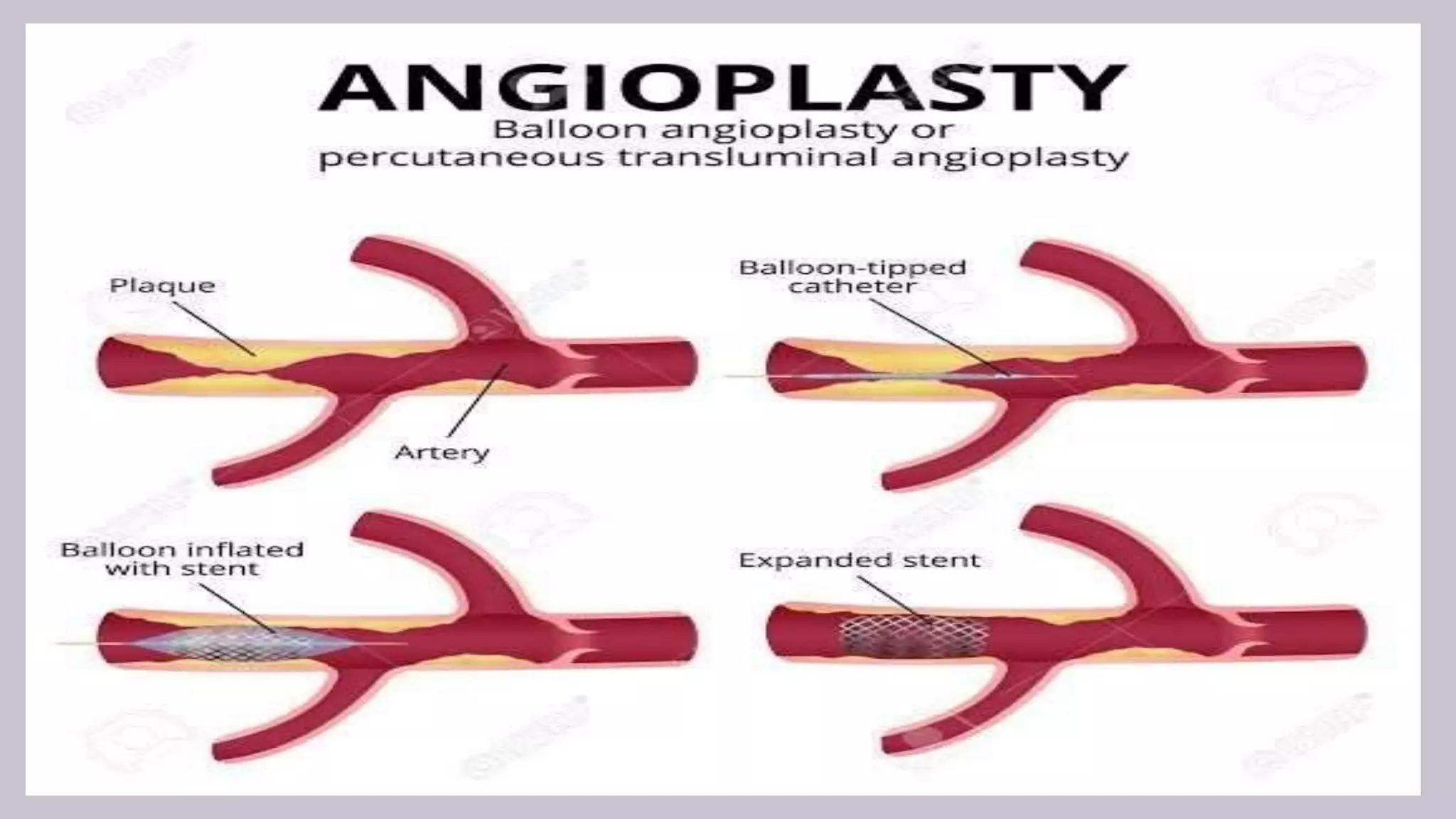 Neuro interventional procedures | PPTX