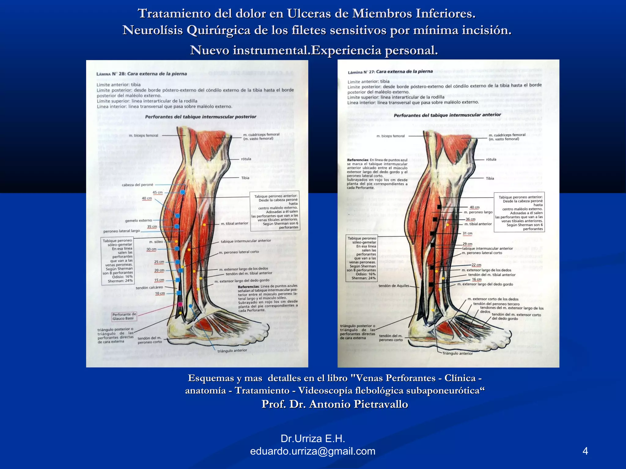 Neurolísis quirúrgica en úlcera de miembros inferiores | PPT