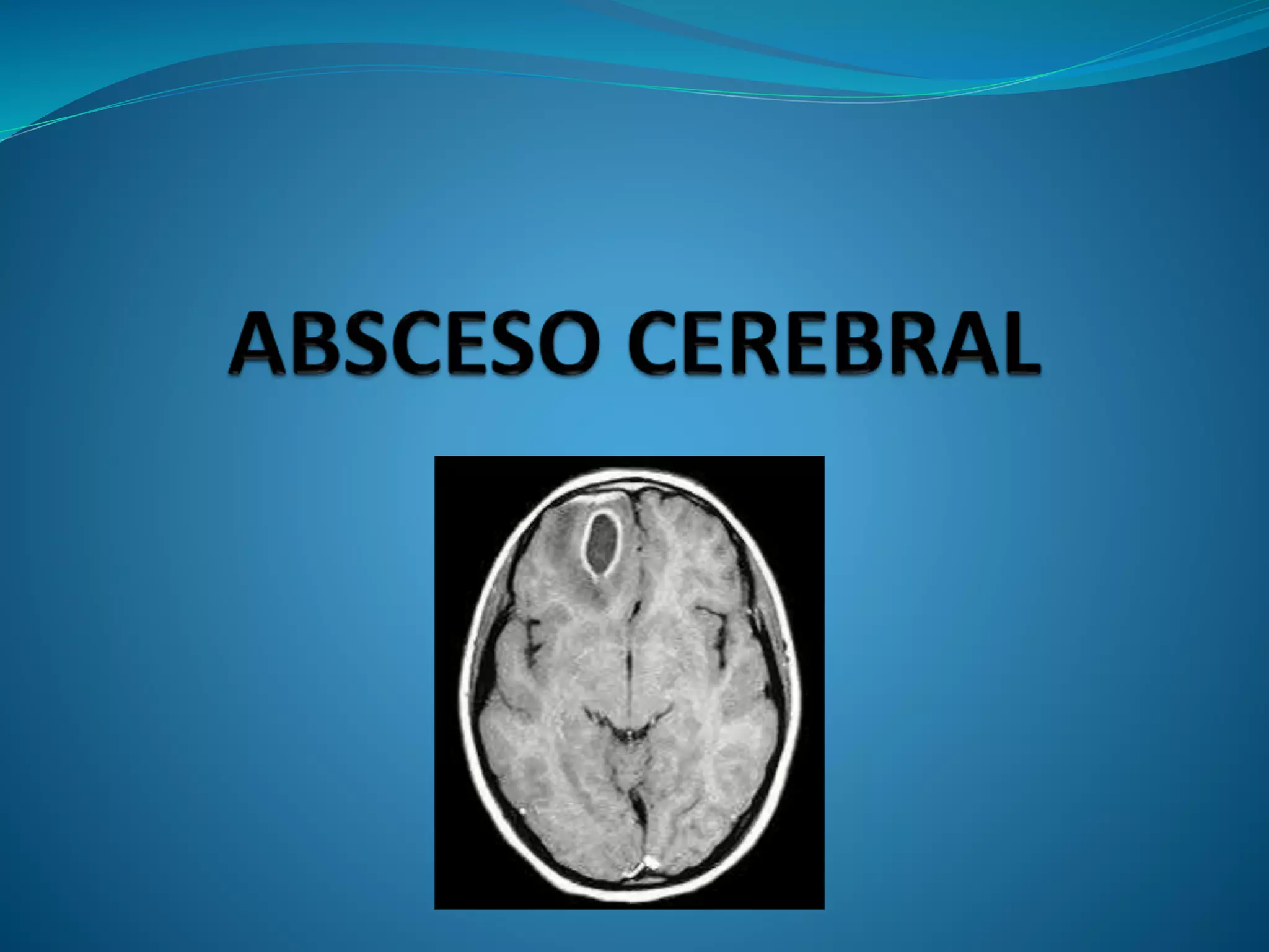 Absceso cerebral | PPTX