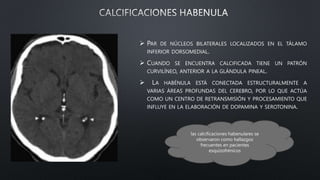 Neurologia Calcificaciones .pptx