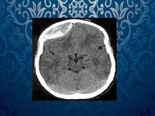 Neurological complications in omfs trauma by Dr. Amit Suryawanshi .Oral ...