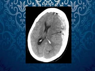 Neurological complications in omfs trauma by Dr. Amit Suryawanshi .Oral ...
