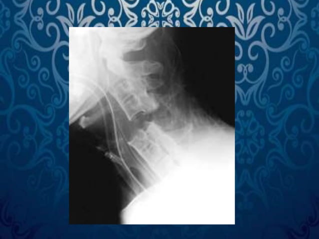 Neurological complications in omfs trauma by Dr. Amit Suryawanshi .Oral ...