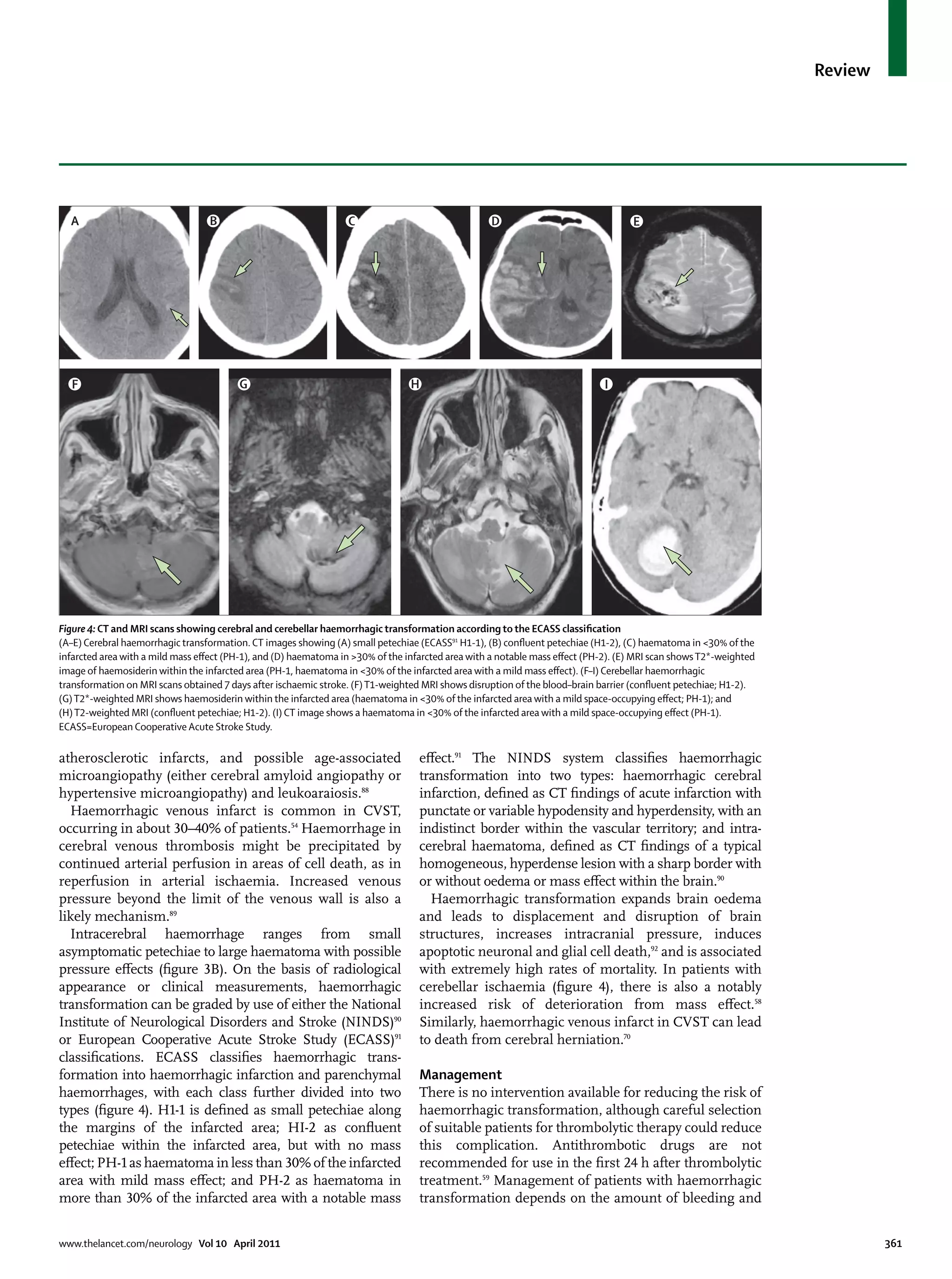 Neurological complications of acute ischaemic stroke | PDF