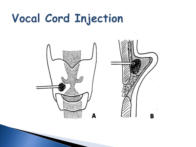 Neurological conditions of larynx ashly | PPTX