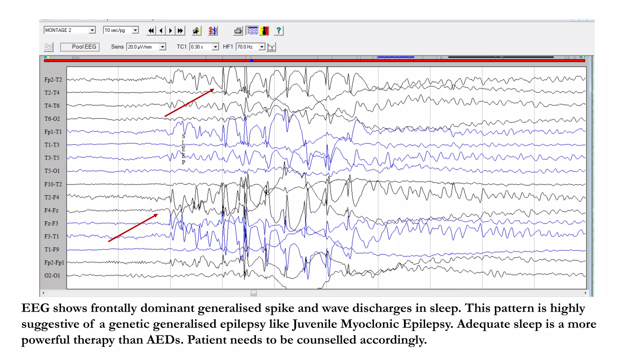 Neurological disorders and sleep | PPTX