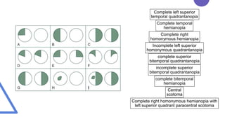 Neurological examination lec 1 vision and ocular system | PPTX