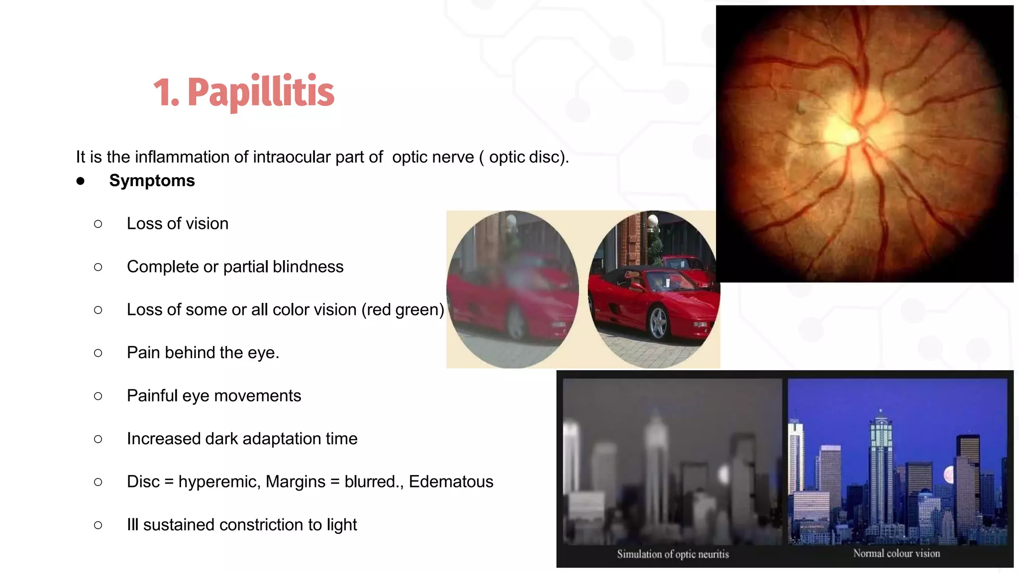 Neurological eye disorder | PDF