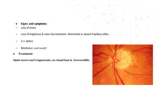 Neurological eye disorder | PPT