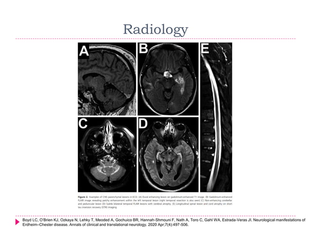 Neurological manifestations of Erdheim–Chester Disease.pptx