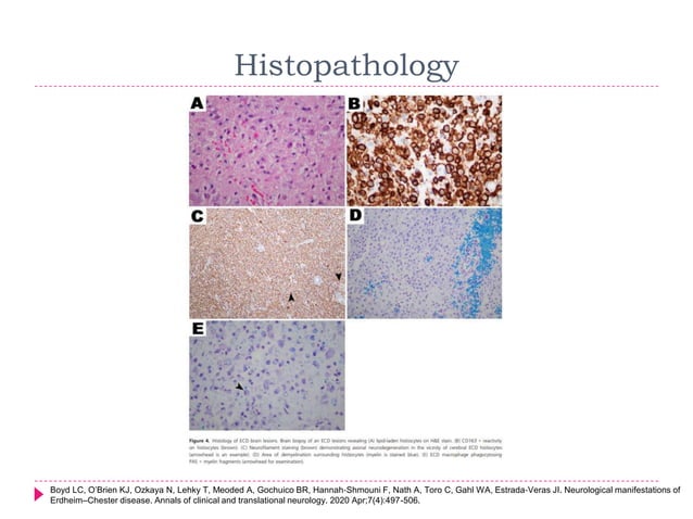 Neurological manifestations of Erdheim–Chester Disease.pptx