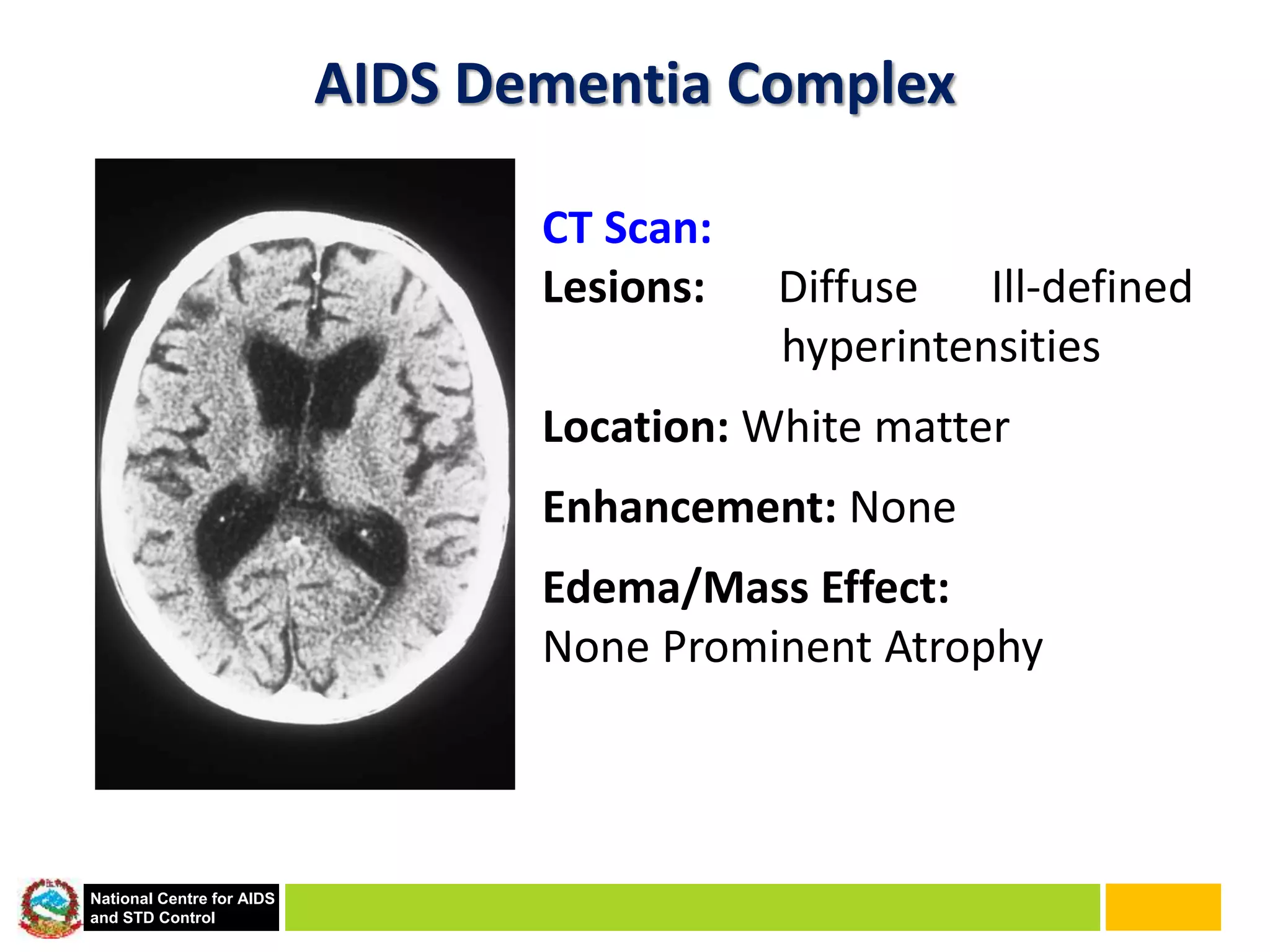 Neurological Manifestations of HIV.ppt