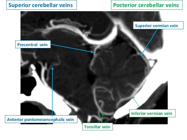 Neurology advanced cerebral veins f heran