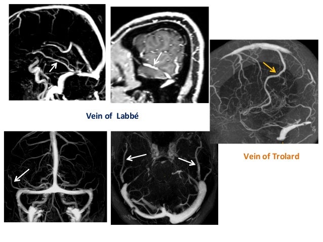Neurology advanced cerebral veins f heran