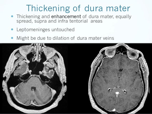 Neurology advanced csf jl sarrazin