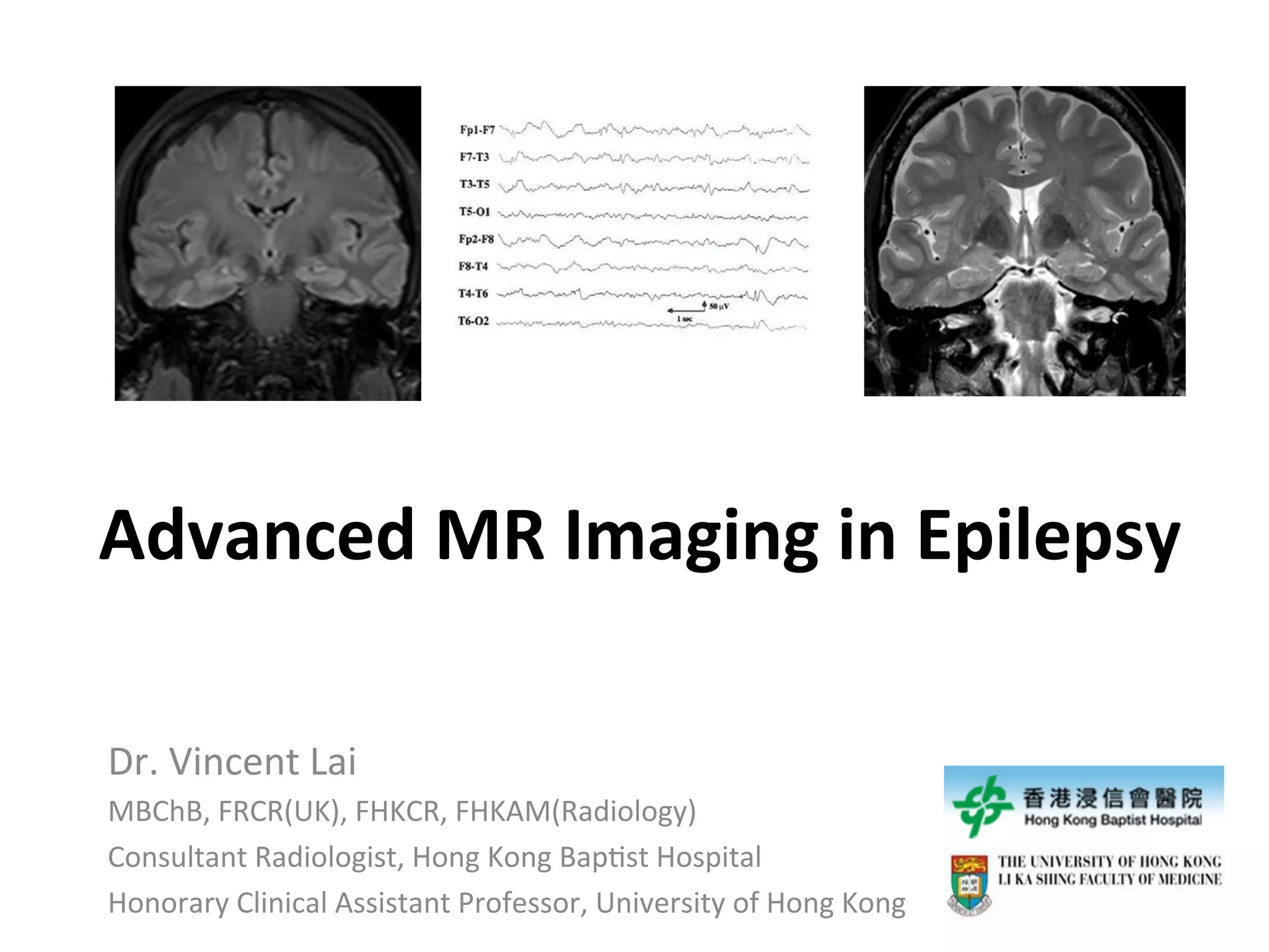 Neurology advanced mr imaging in epilepsy v lai | PDF