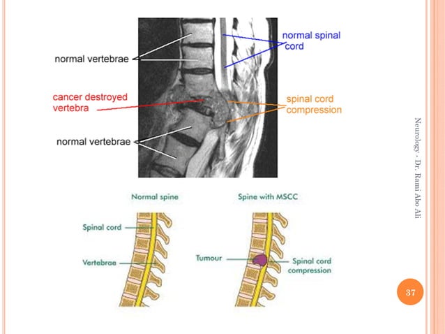 Neurology 12th disorders of the spine and spinal cord | PPT