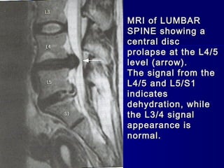 Neurology(intervertebral+disease) | PPT