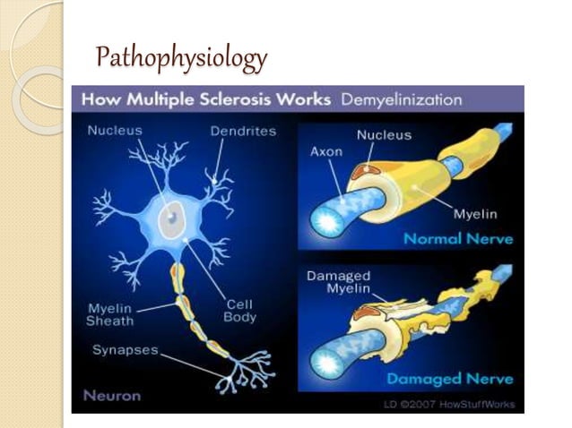 Neurology(multiple sclerosis) | PPTX