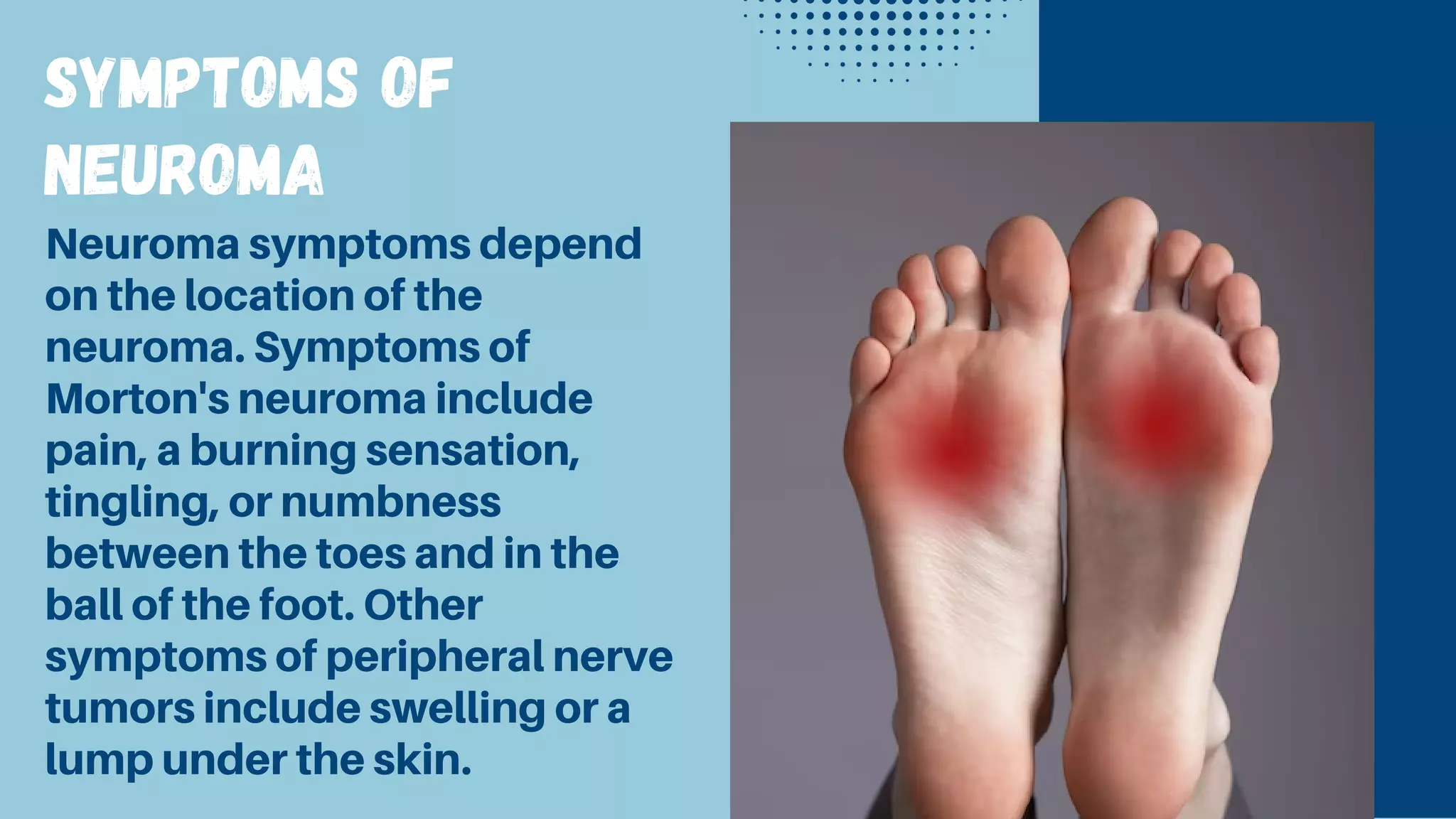 Neuroma Symptoms, Causes & Treatments | PPT