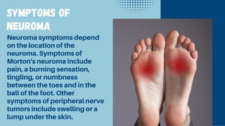 Neuroma Symptoms, Causes & Treatments | PPT