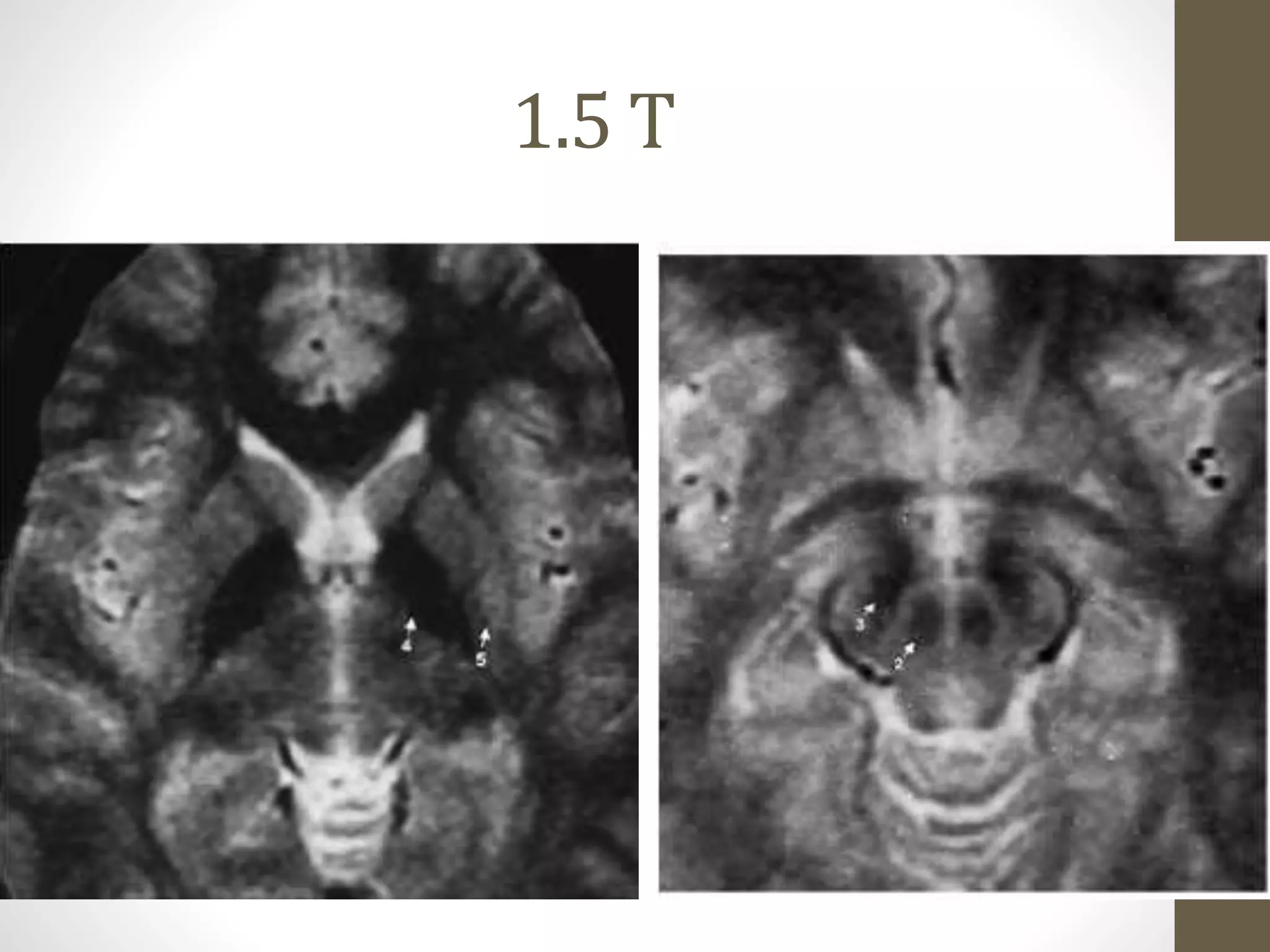 Neurodegeneretaion with Brain Iron Accumulation (NBIA) and Normal Brain ...