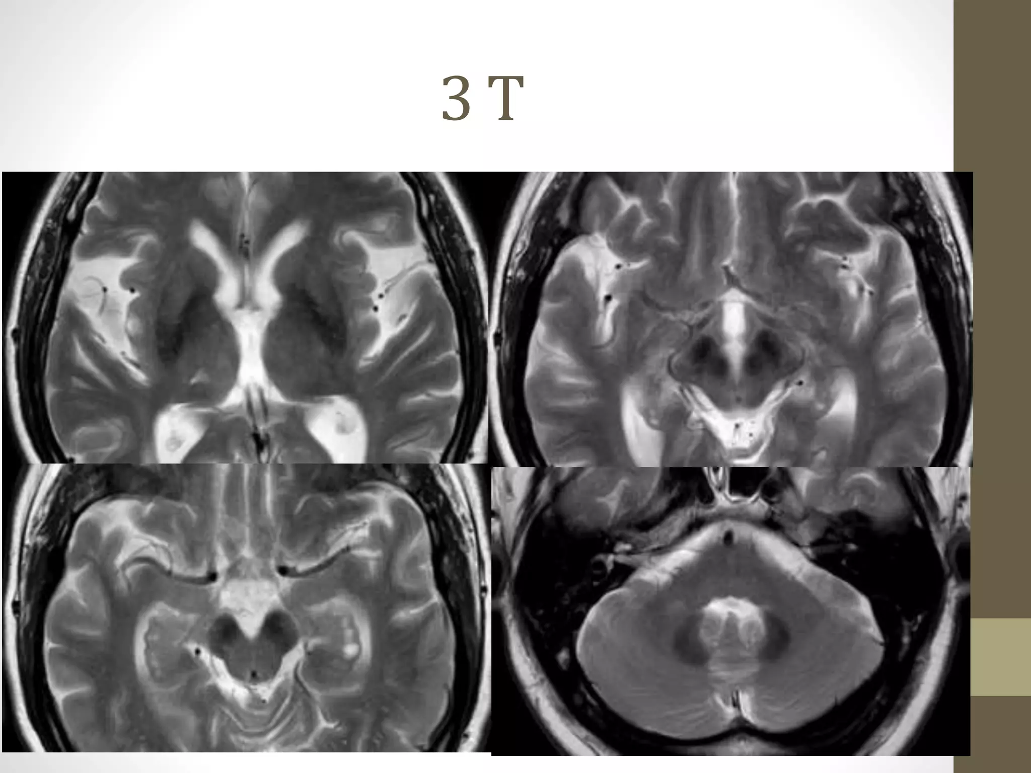 Neurodegeneretaion with Brain Iron Accumulation (NBIA) and Normal Brain ...