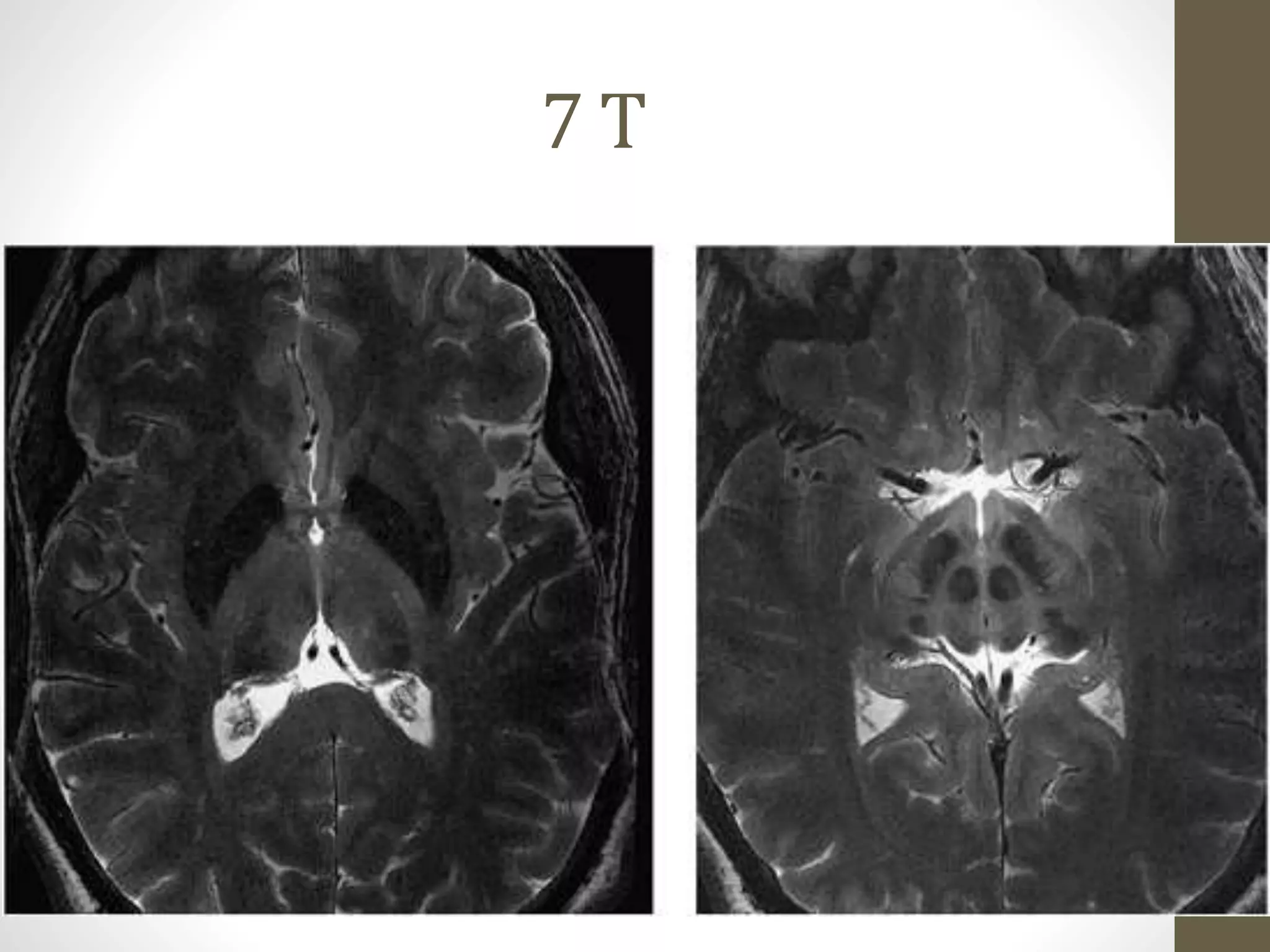 Neurodegeneretaion with Brain Iron Accumulation (NBIA) and Normal Brain ...