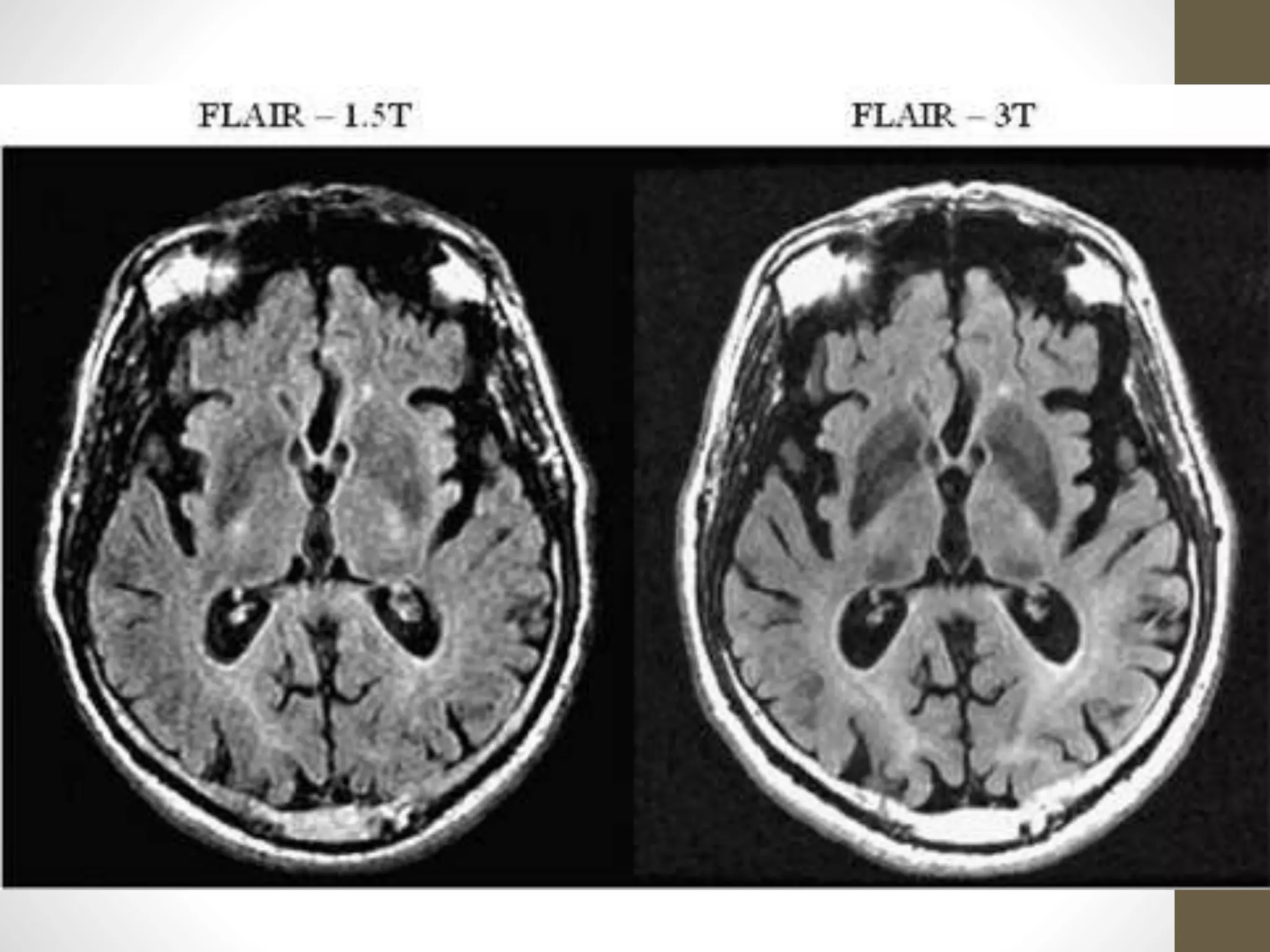 Neurodegeneretaion with Brain Iron Accumulation (NBIA) and Normal Brain ...