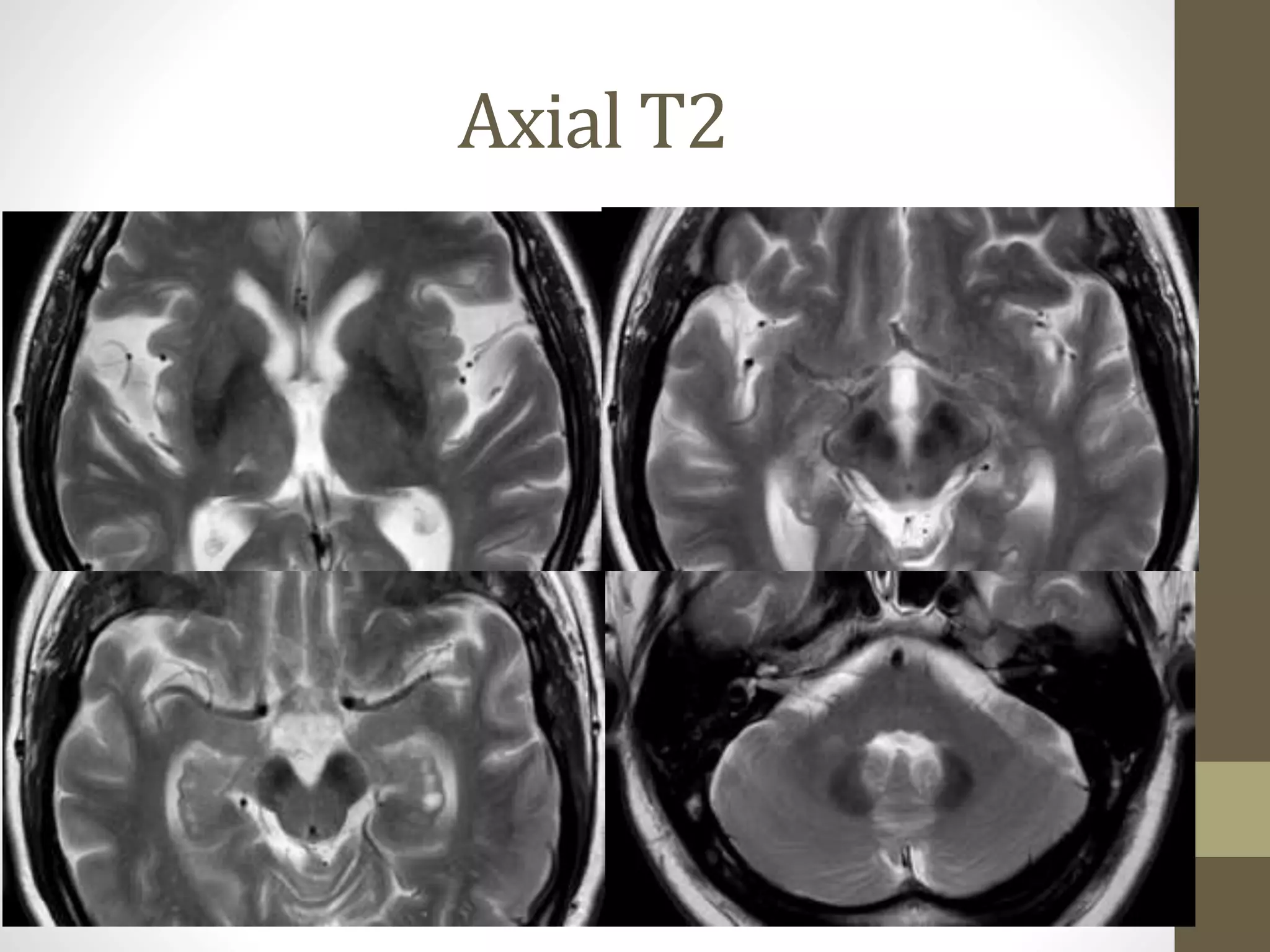 Neurodegeneretaion with Brain Iron Accumulation (NBIA) and Normal Brain ...