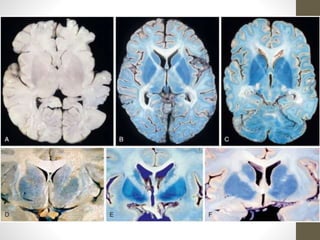 Neurodegeneretaion with Brain Iron Accumulation (NBIA) and Normal Brain ...
