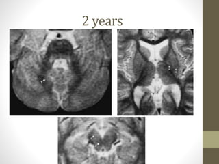 Neurodegeneretaion with Brain Iron Accumulation (NBIA) and Normal Brain ...
