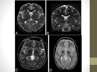 Neurodegeneretaion with Brain Iron Accumulation (NBIA) and Normal Brain ...