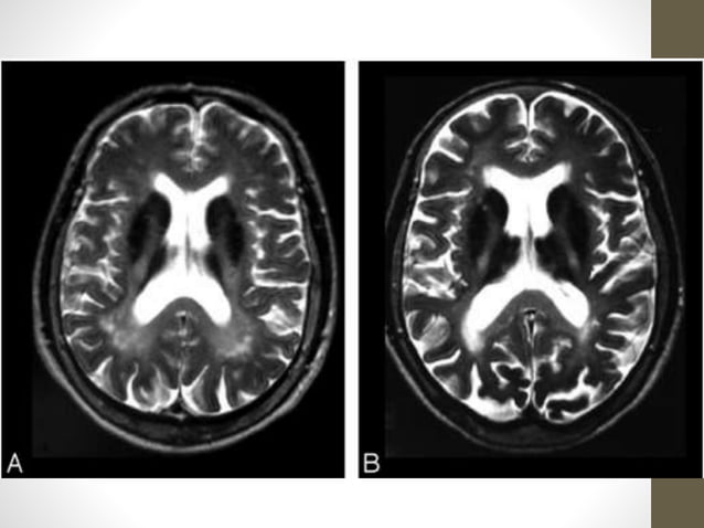 Neurodegeneretaion with Brain Iron Accumulation (NBIA) and Normal Brain ...